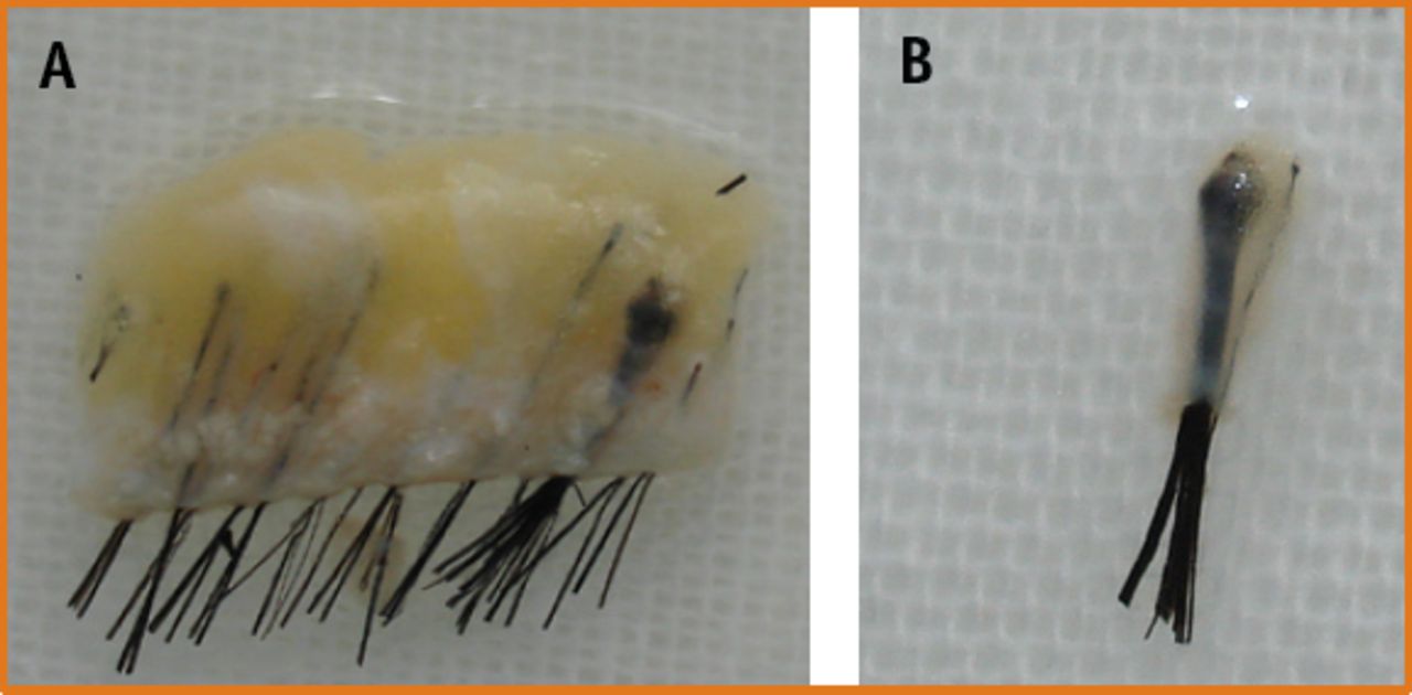 Multiple Hairs In One Follicle Multiple Hairs In One Follicle