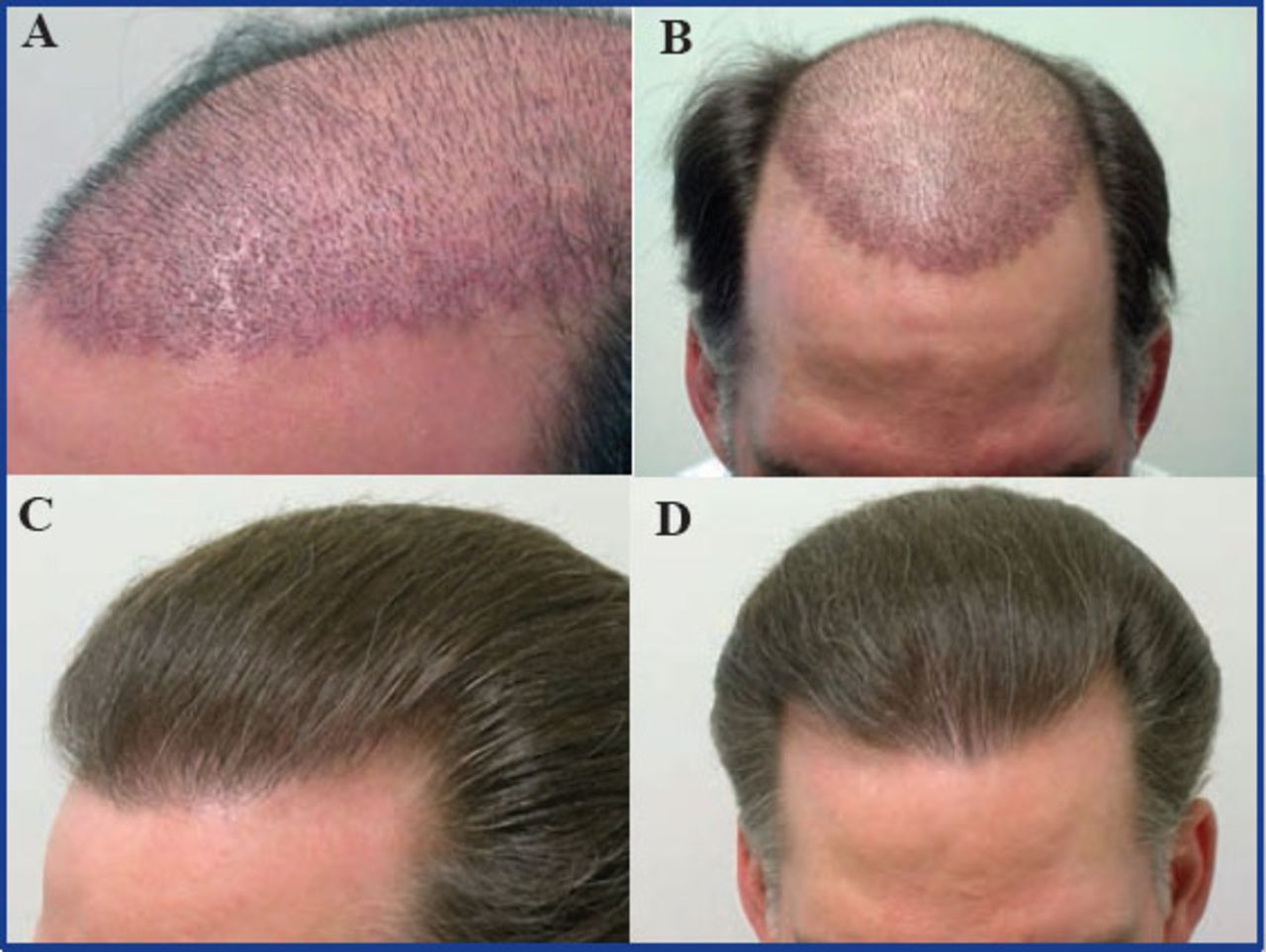 Top 136 How Many Hair In One Graft Of Hair Transplant